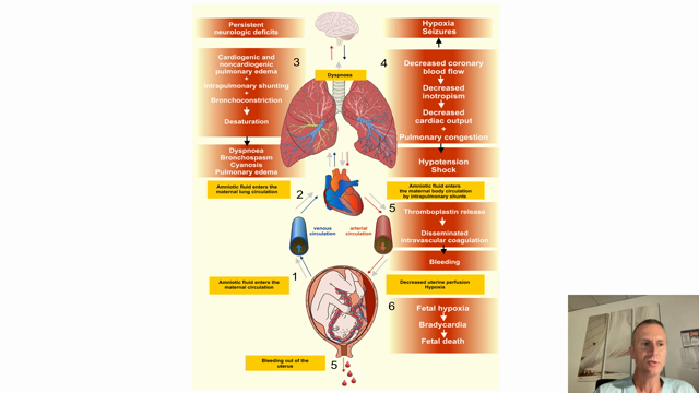 - Embolie Amniotique (Pottecher)
