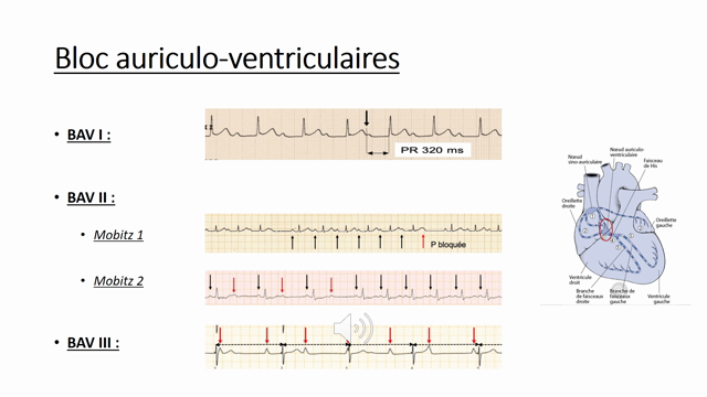 - Ecg : Troubles De La Conduction (Duthil)