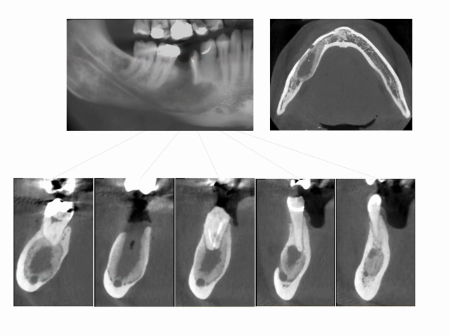 - Kystes Maxillaires Dfgso3 Partie 2